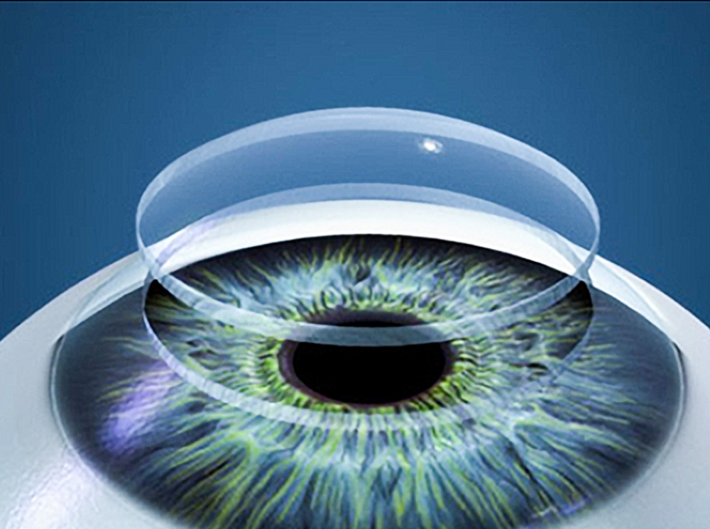 Corneal Transplantation | فيمتوليزك وعمليات العيون وتصحيح البصر